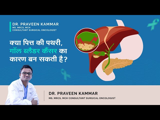 Does gallstone cause gallbladder cancer? | Dr. Praveen Kammar
